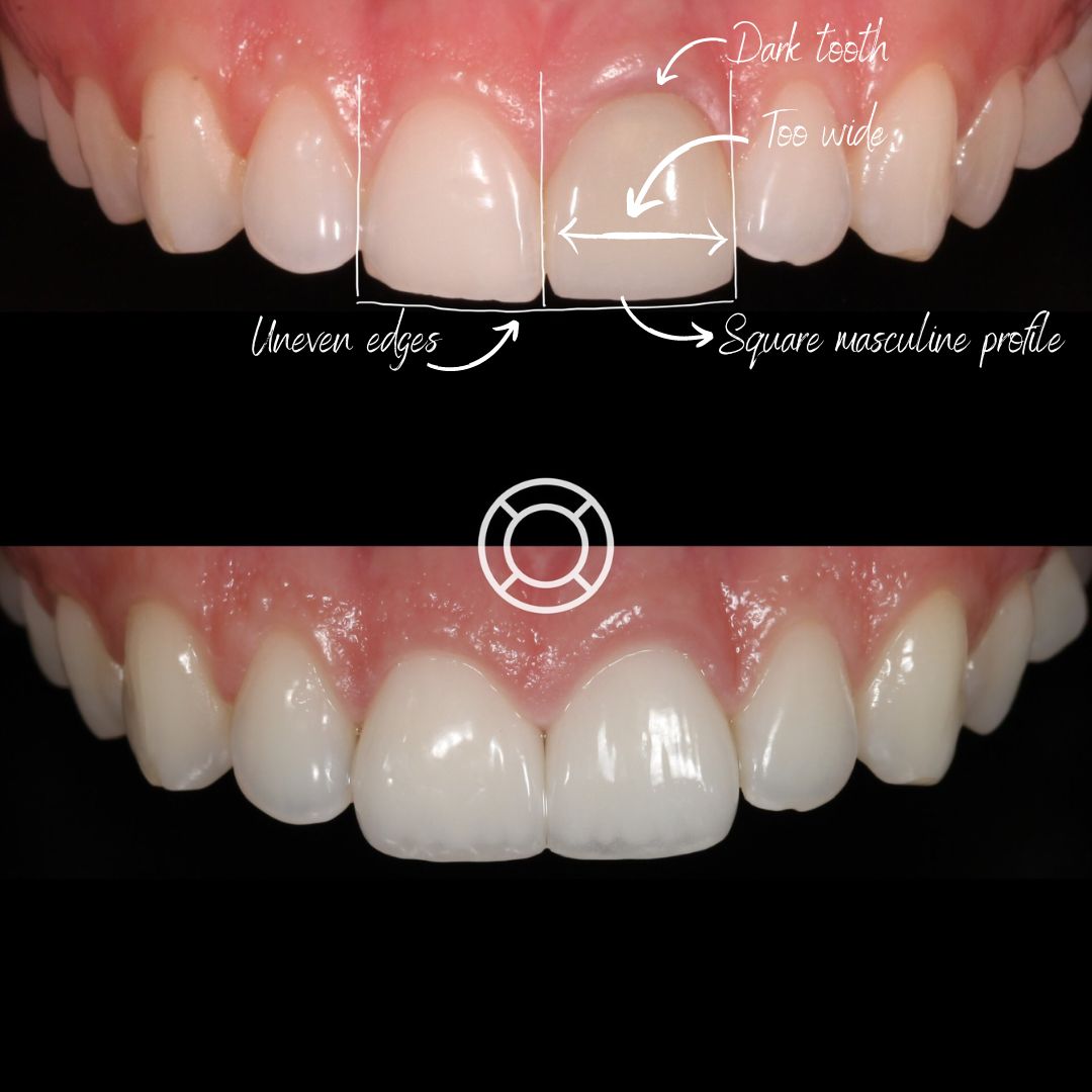 Before and After: Ceramic Crowns to Fix a Dark Front Tooth - Warragul ...